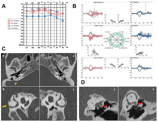 Posterior Semicircular Canal Dehiscence with Vestibulo-Ocular Reflex ...