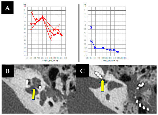 Otic Capsule Dehiscences Simulating Other Inner Ear Diseases ...