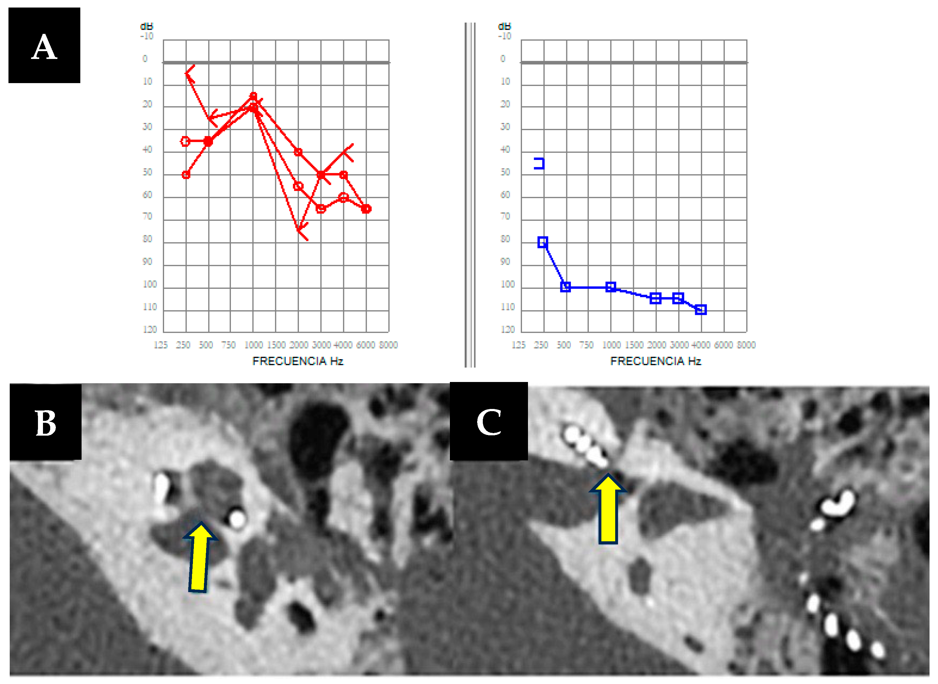 Otic Capsule Dehiscences Simulating Other Inner Ear Diseases ...