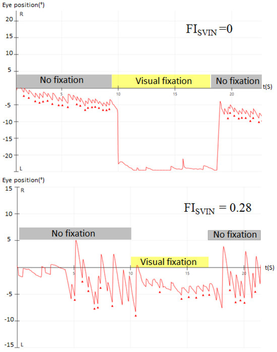 Visual Fixation of Skull-Vibration-Induced Nystagmus in Patients with ...