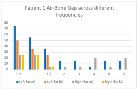 Air–Bone Gap in Meniere’s Disease: A Case Series and Literature Review