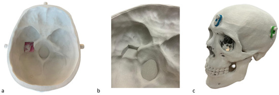 A 3D-Printed Educational Model for First-Line Management of BPPV in ...