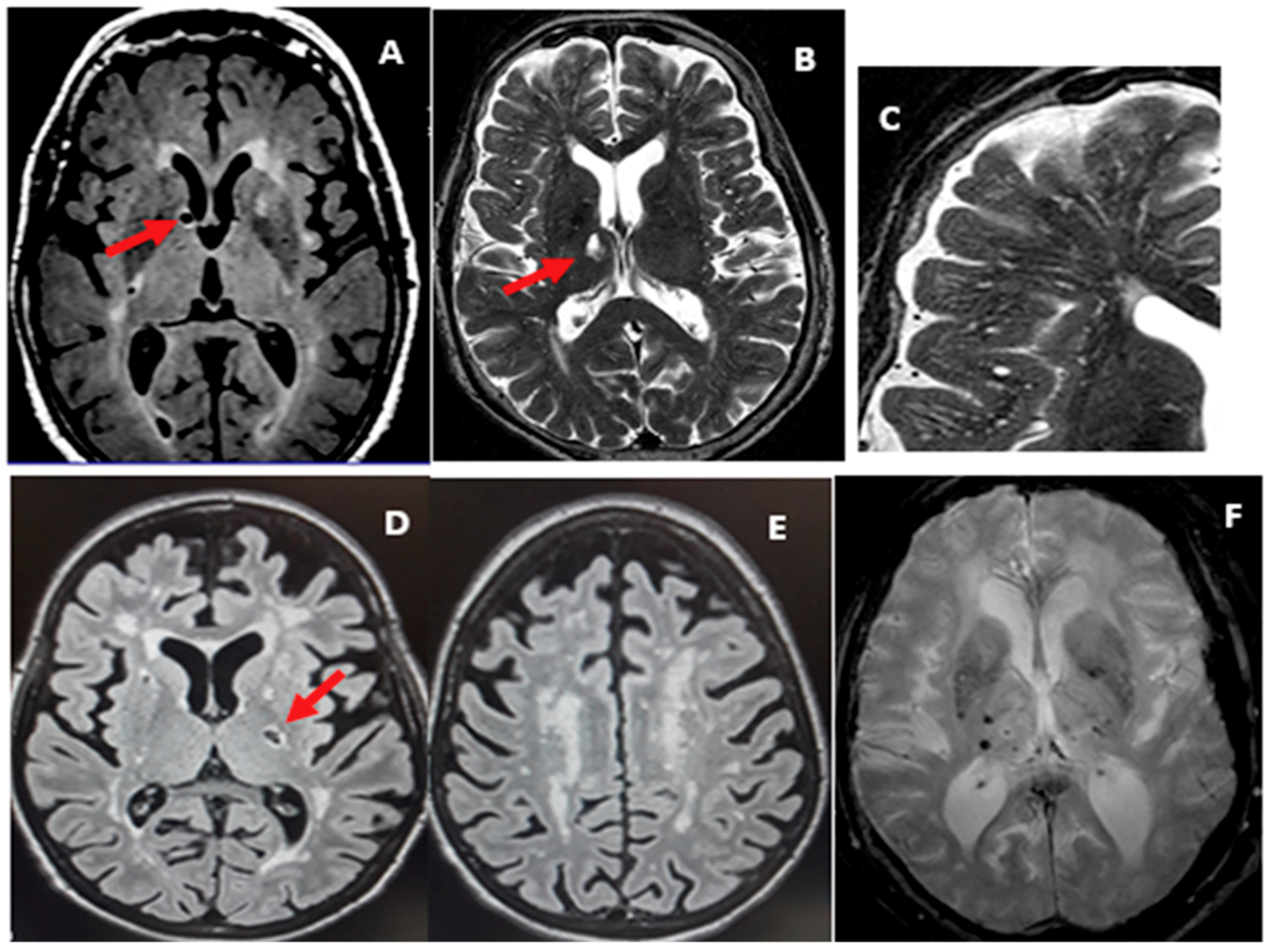 Behavioral Sciences Free Full Text Cerebral Small Vessel Disease