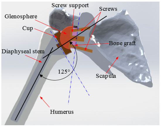 A Study of the Biomechanical Behavior of the Implantation Method of ...