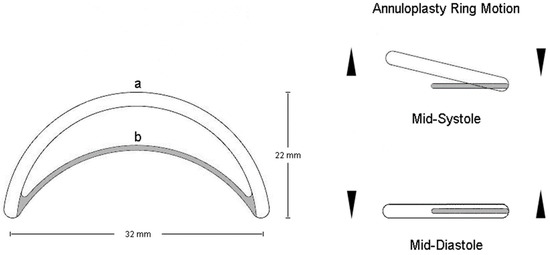 The Impact of a New “Inverted Arch” Prosthetic Annuloplasty Ring on the ...