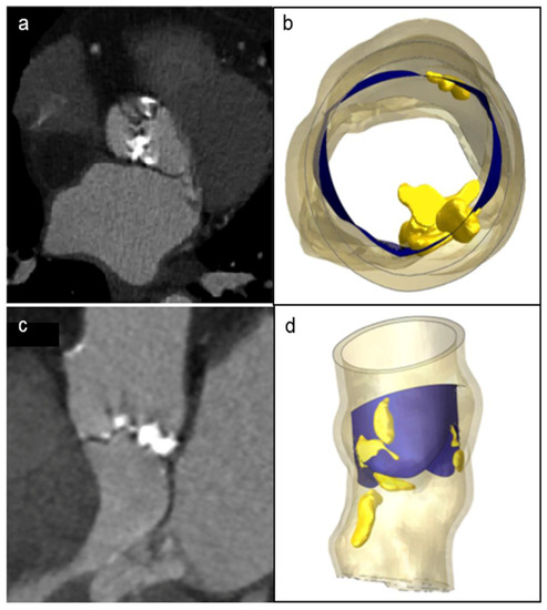 CoreValve vs. Sapien 3 Transcatheter Aortic Valve Replacement: A Finite ...