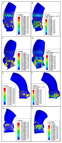 CoreValve vs. Sapien 3 Transcatheter Aortic Valve Replacement: A Finite ...