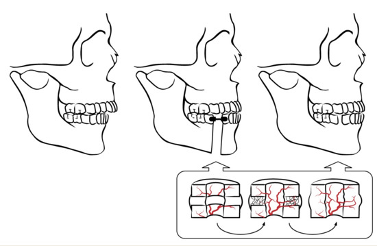 Bioengineering | Free Full-Text | A New Orthodontic-Surgical Approach ...