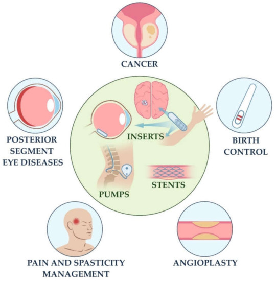 Bioengineering Free Full Text Implantable Drug Delivery Systems And