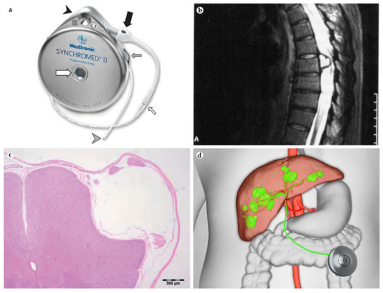 Bioengineering | Free Full-Text | Implantable Drug Delivery Systems and ...