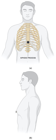 Detection of Aortic Valve Opening and Estimation of Pre-Ejection Period ...