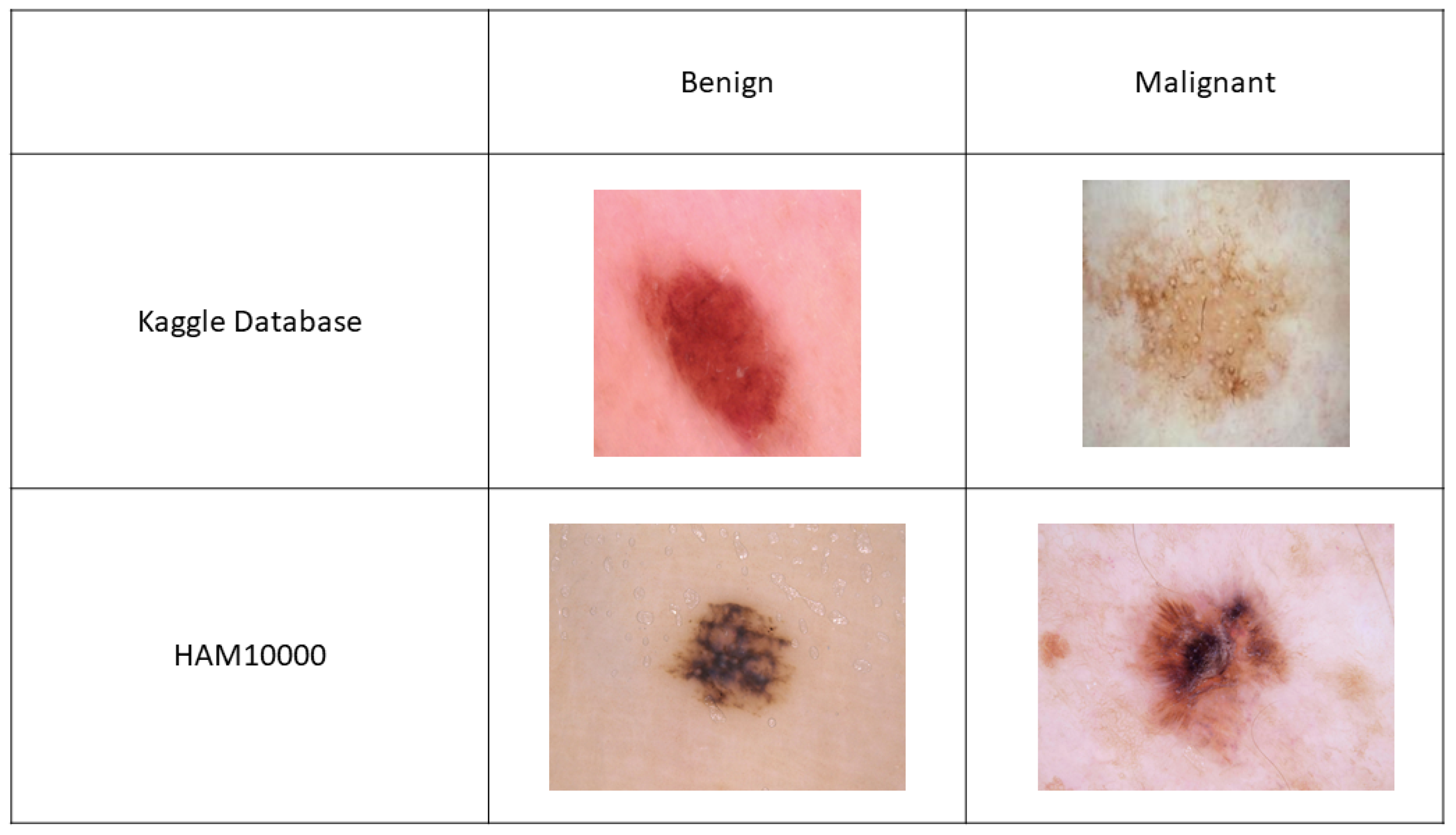 Skin Cancer Malignant Vs Benign Kaggle