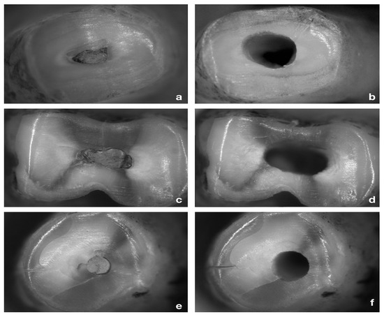 In Vitro Qualitative Evaluation of Root-End Preparation Performed by ...