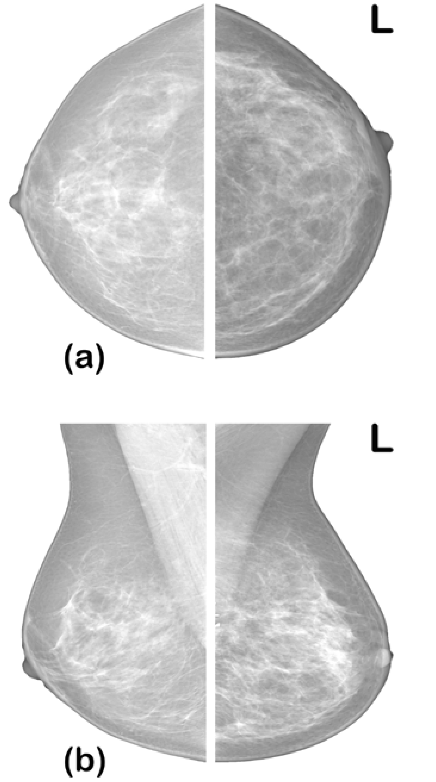 Bioengineering | Free Full-Text | Performance Evaluation of Deep Learning Models on Mammogram ...