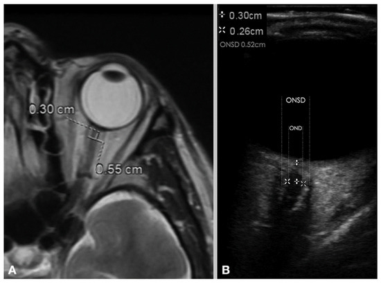 A Review of the Methods of Non-Invasive Assessment of Intracranial ...