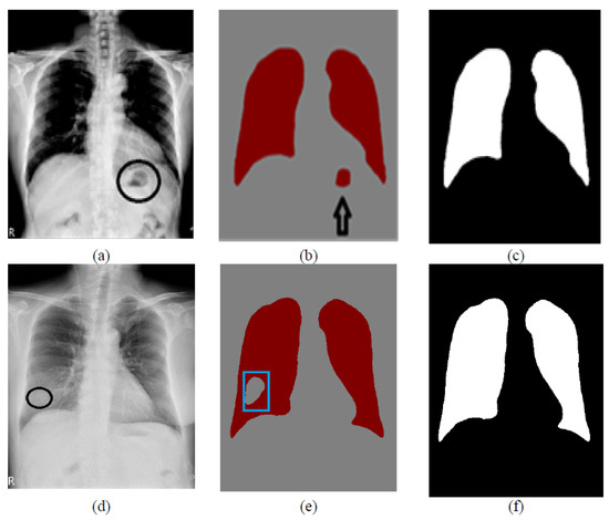 Bioengineering | Free Full-Text | Lung Field Segmentation in Chest X ...