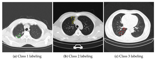 Detection and Classification of Bronchiectasis Based on Improved Mask-RCNN
