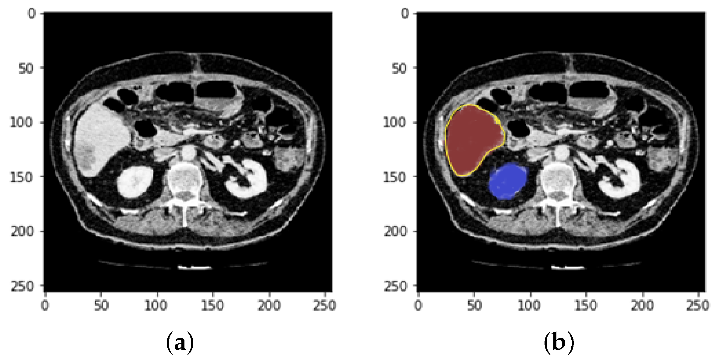 A Deep Learning Approach for Liver and Tumor Segmentation in CT Images Using ResUNet