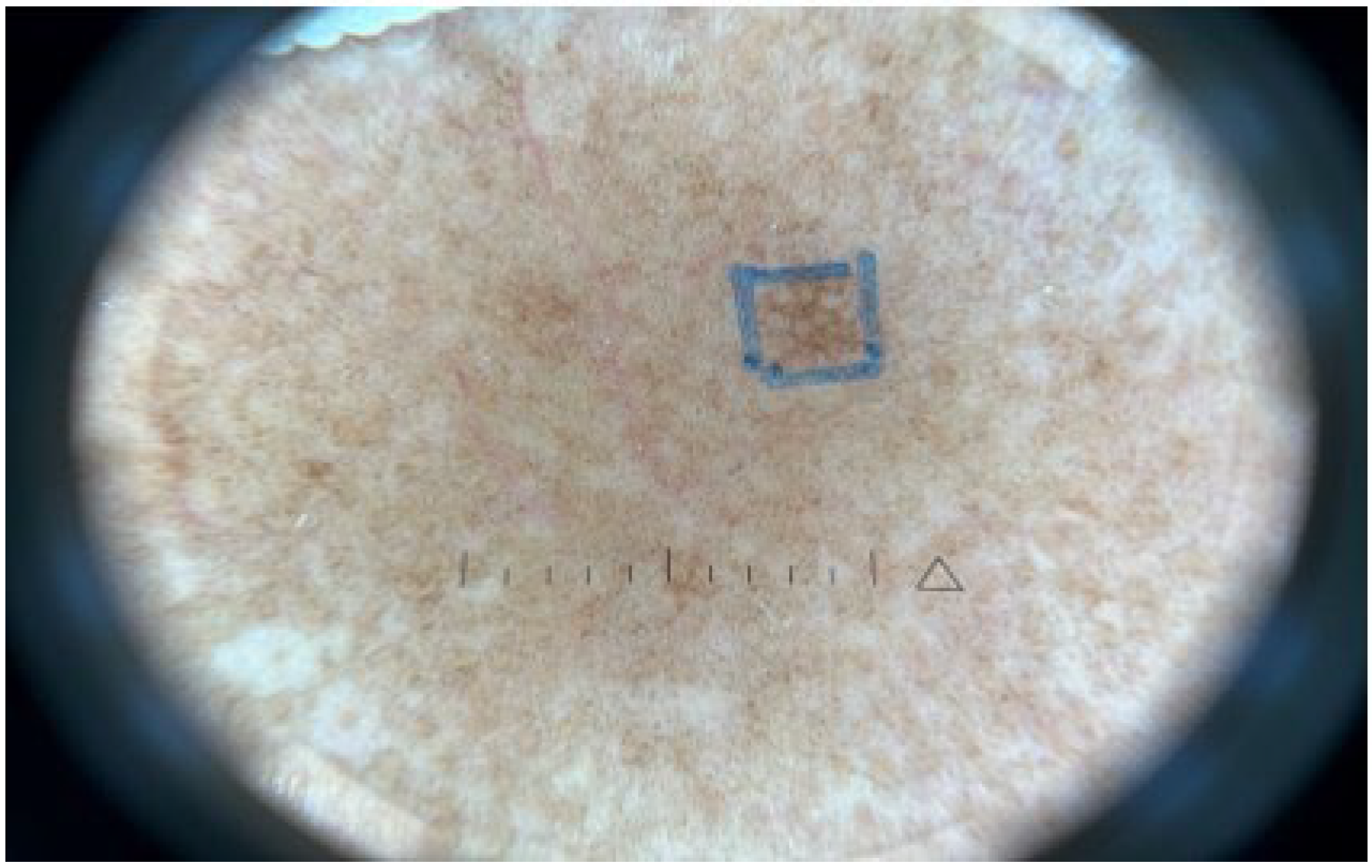 Riehl’s Melanosis: A Multimodality, In Vivo, Real-Time Skin Imaging ...