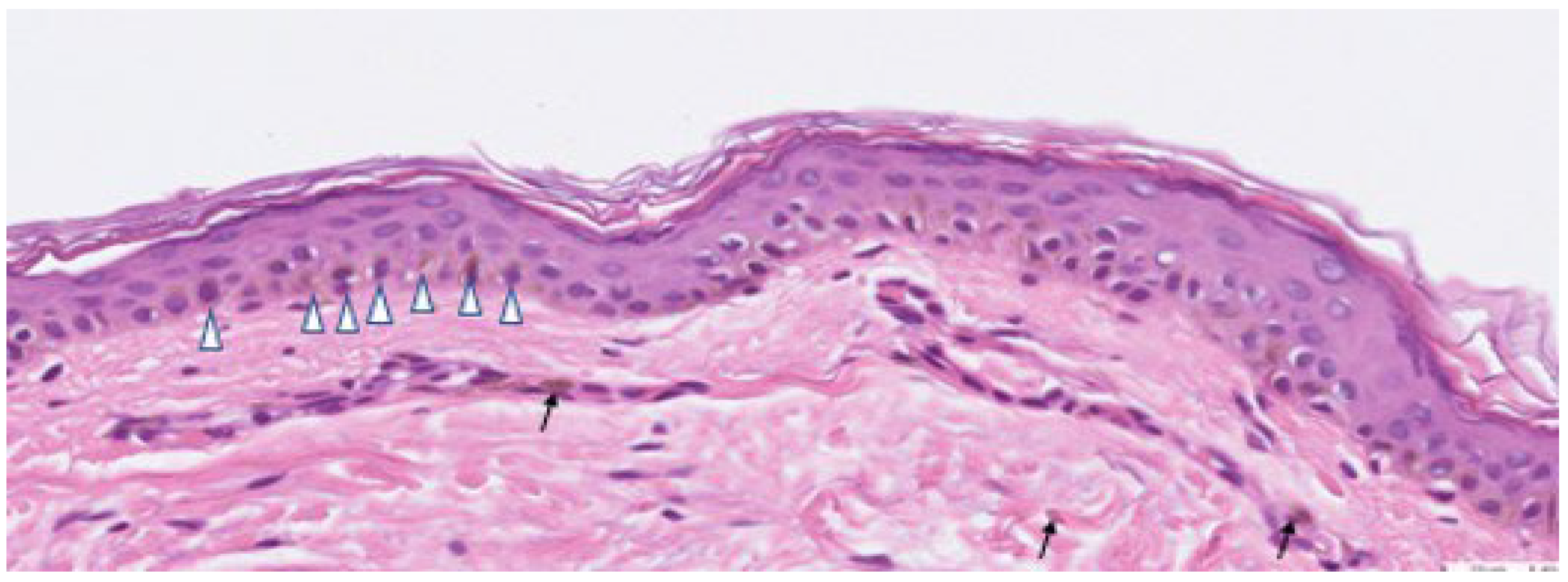 Riehl’s Melanosis: A Multimodality, In Vivo, Real-Time Skin Imaging ...