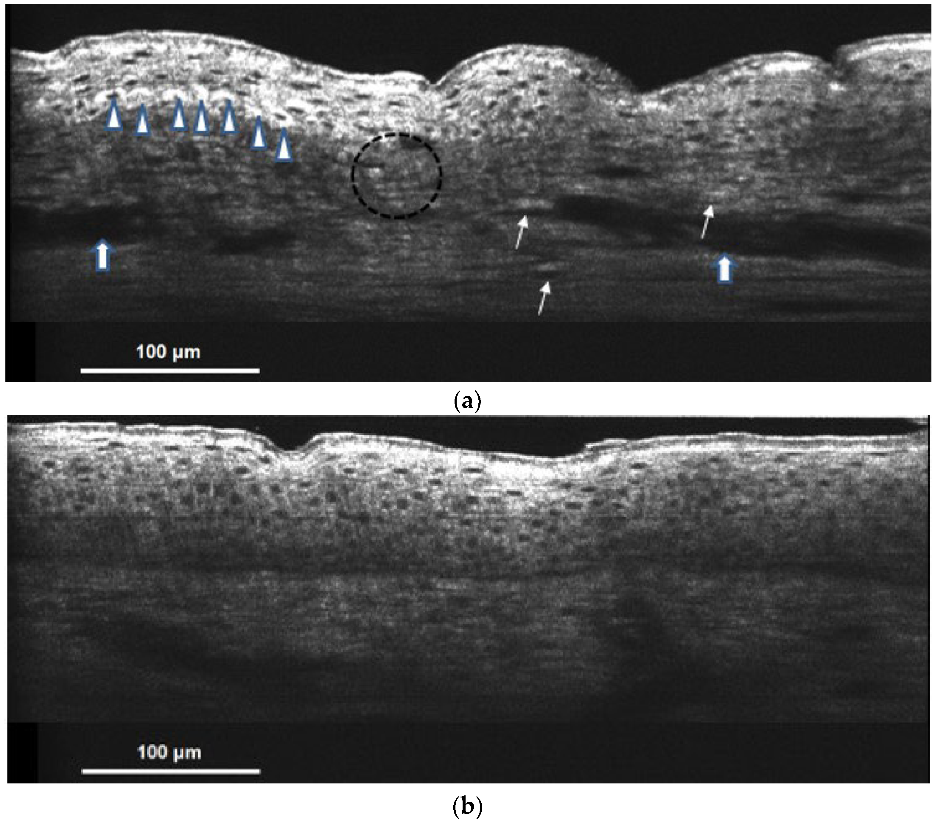 Riehl’s Melanosis: A Multimodality, In Vivo, Real-Time Skin Imaging ...