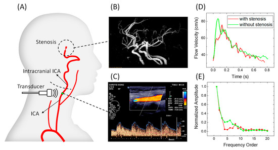 Early Diagnosis of Intracranial Internal Carotid Artery Stenosis Using ...