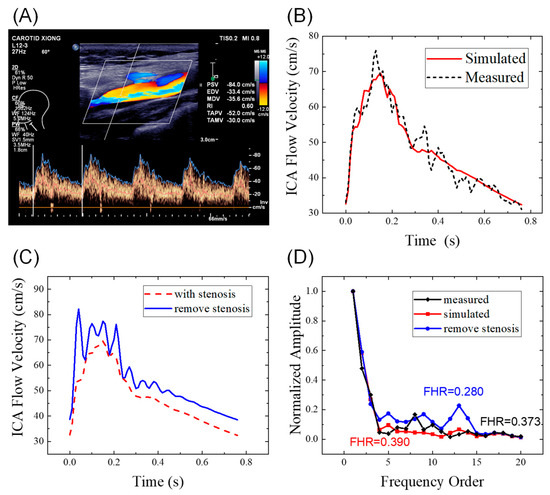 Early Diagnosis of Intracranial Internal Carotid Artery Stenosis Using ...