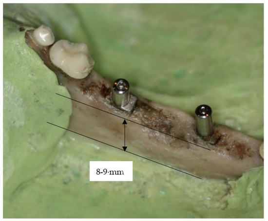 The Biomechanical Profile of an Osseo-Integrated Rectangular Block ...