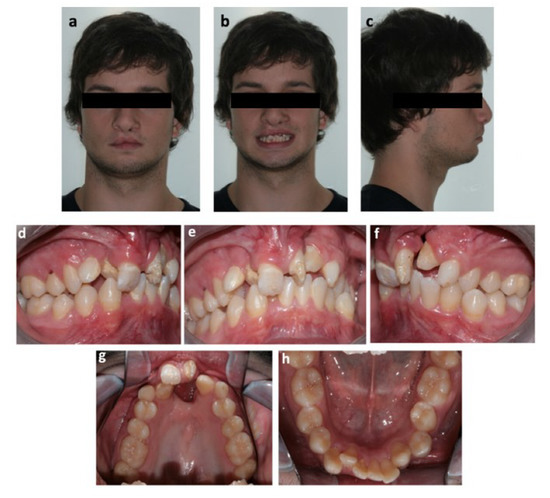 Bioengineering | Free Full-Text | Reconstruction of Oronasal Fistula ...