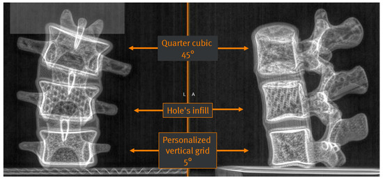 Virtual Scoliosis Surgery Using a 3D-Printed Model Based on Biplanar ...