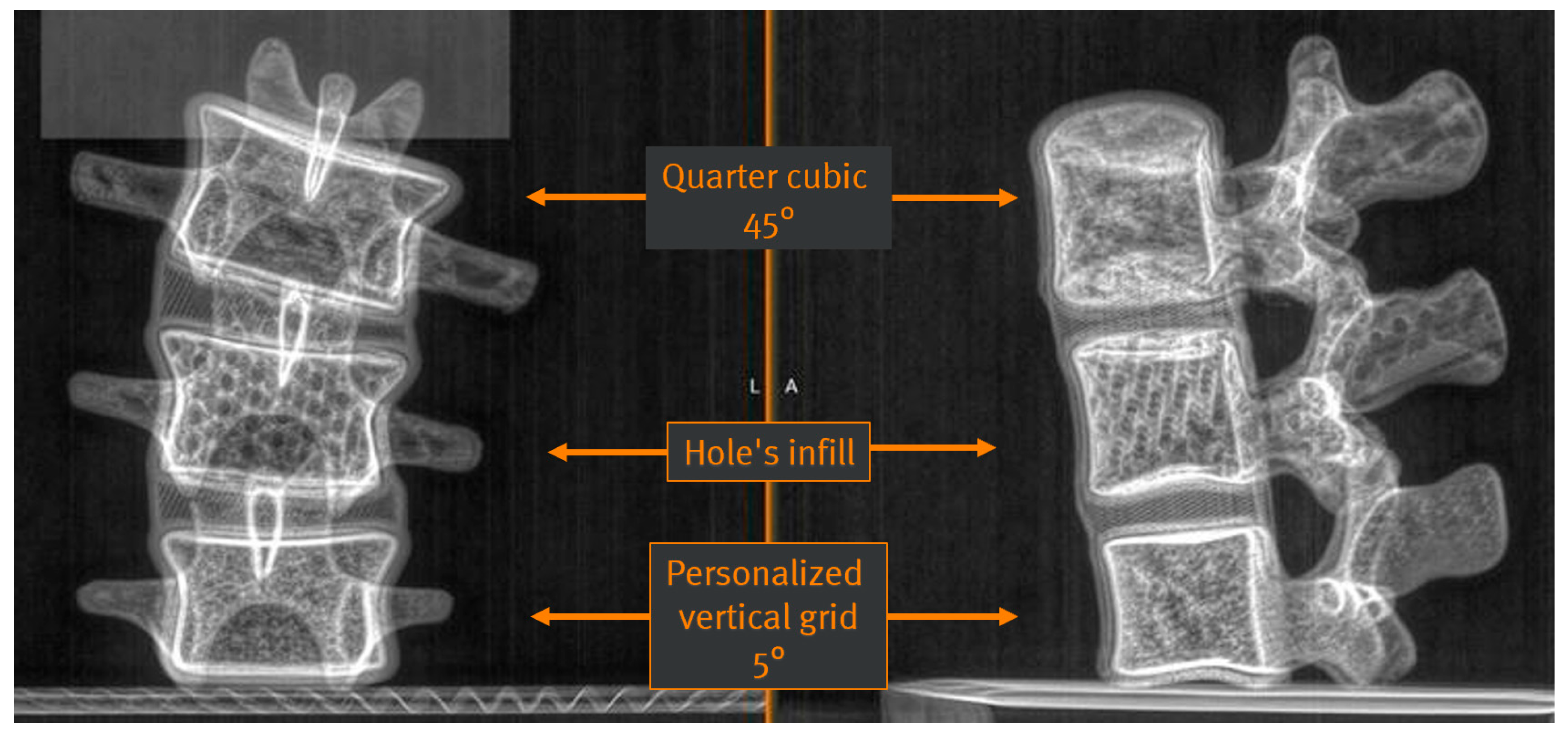 Virtual Scoliosis Surgery Using a 3D-Printed Model Based on Biplanar ...