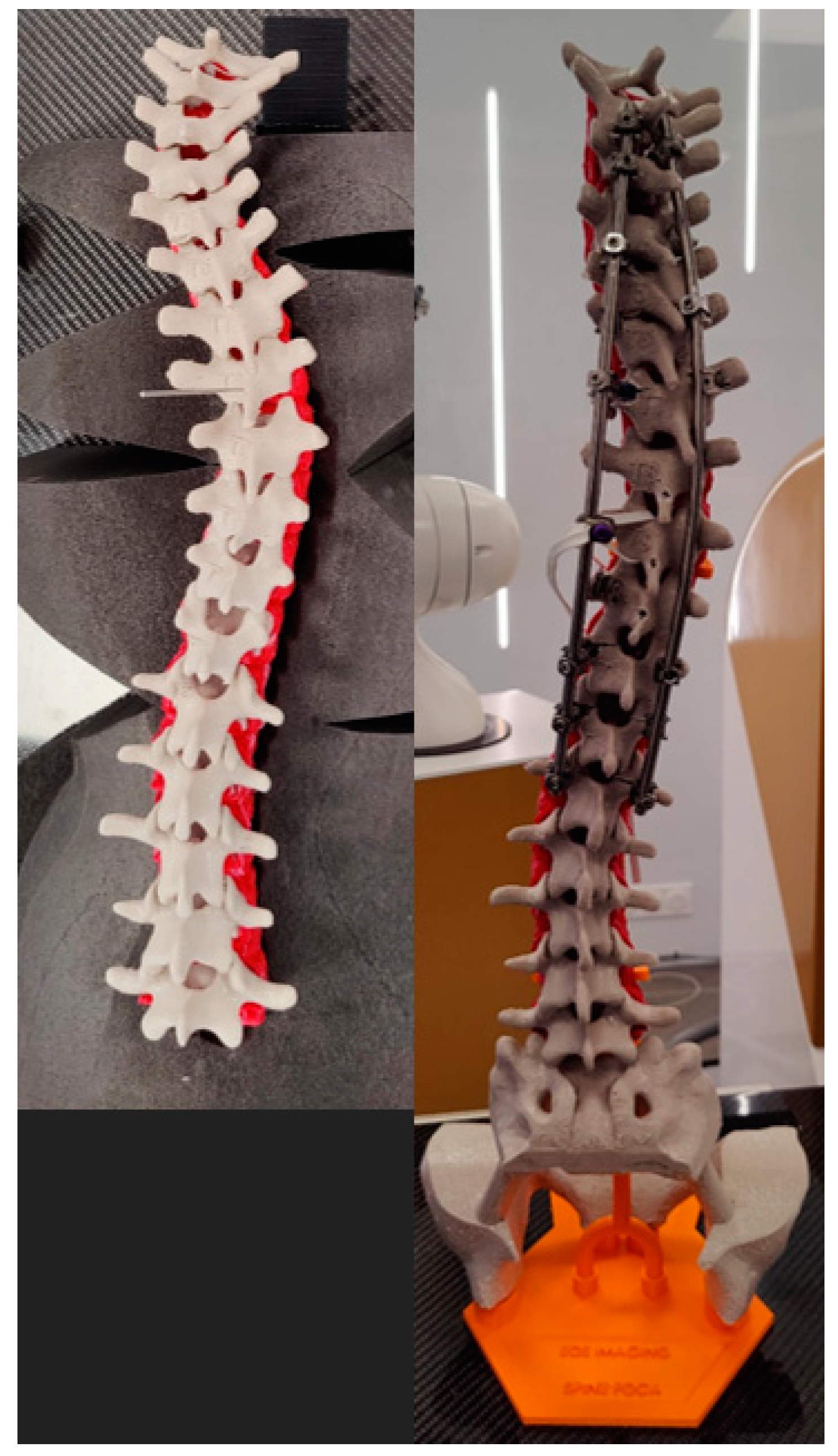 3d Printed Vertebrae