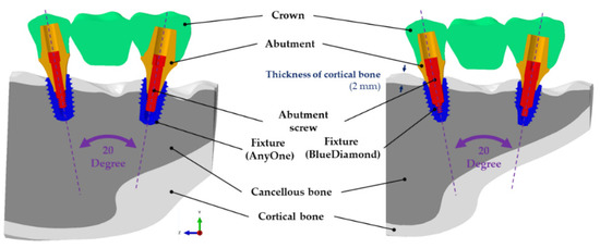Finite Element Analysis of a New Non-Engaging Abutment System for Three ...