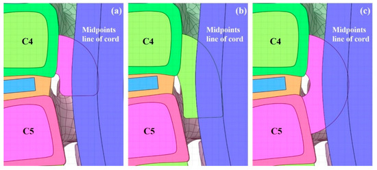 Stress Distribution on Spinal Cord According to Type of Laminectomy for ...