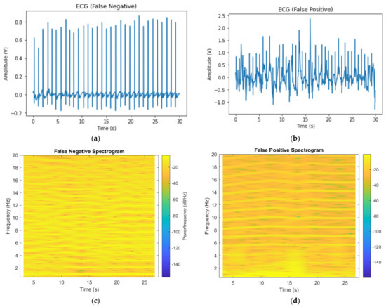 Automated Atrial Fibrillation Detection with ECG