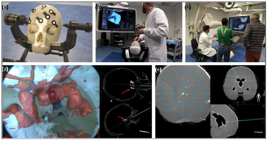 Development of a CT-Compatible, Anthropomorphic Skull and Brain Phantom ...