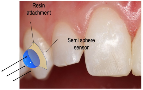 Smart Flexible 3D Sensor for Monitoring Orthodontics Forces: Prototype ...