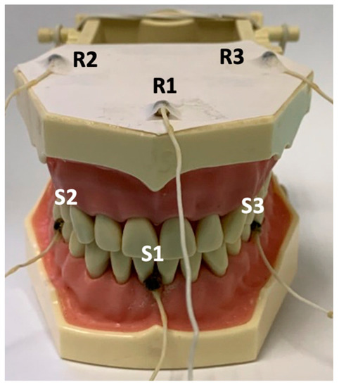 A Novel Technique to Accurately Measure Mouth Opening Using 3D ...