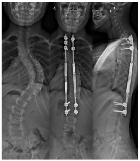 Surgical Treatment of Pediatric Scoliosis: Historical Origins and ...