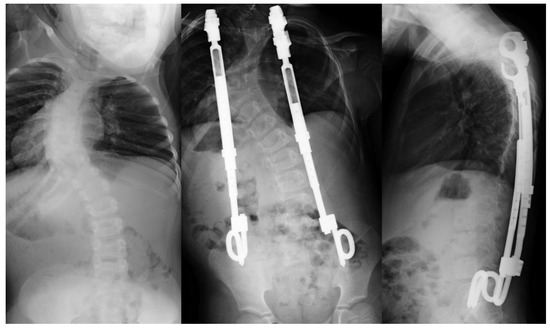 Surgical Treatment of Pediatric Scoliosis: Historical Origins and ...