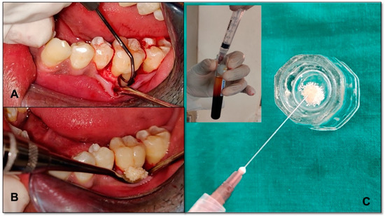 Effect of Injectable Platelet-Rich Fibrin with a Nano-Hydroxyapatite ...