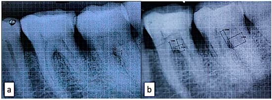 Effect of Injectable Platelet-Rich Fibrin with a Nano-Hydroxyapatite ...