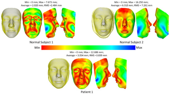 Bioengineering | Free Full-Text | Fast 3D Face Reconstruction from a ...