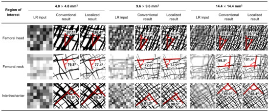 Topology Optimization-Based Localized Bone Microstructure Reconstruction for Image Resolution ...