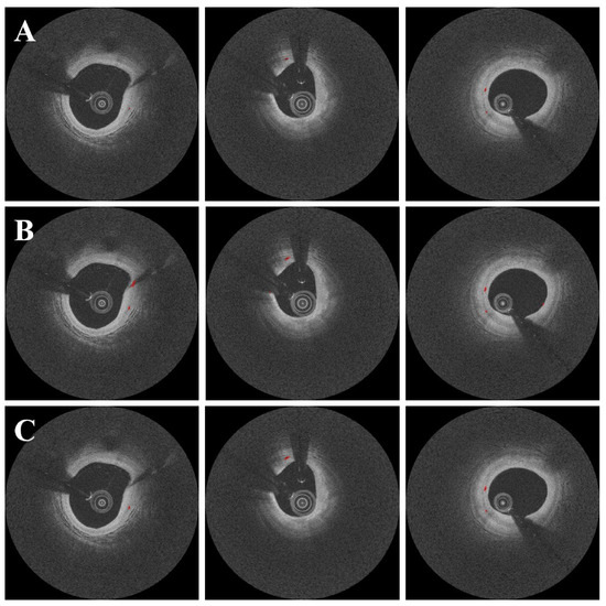 Automated Segmentation of Microvessels in Intravascular OCT Images ...