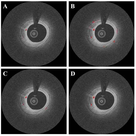 Bioengineering | Free Full-Text | Automated Segmentation of Microvessels in Intravascular OCT ...
