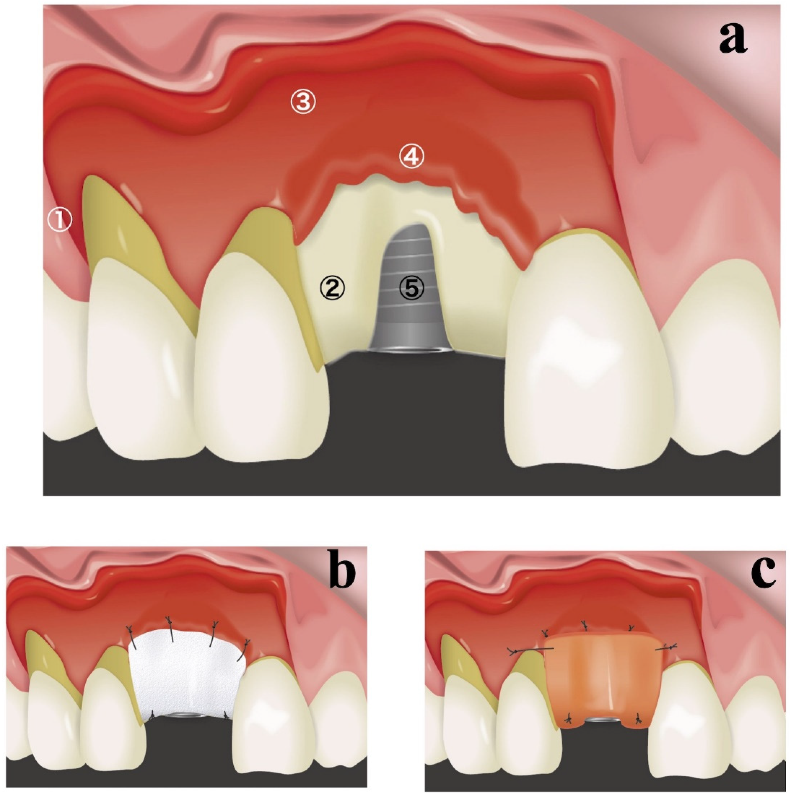 Bioengineering | Free Full-Text | Resorbable Membrane Pouch Technique ... Bioengineering | Free Full-Text | Resorbable Membrane Pouch Technique ...