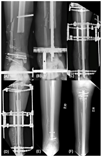 3D-Printing for Critical Sized Bone Defects: Current Concepts and ...