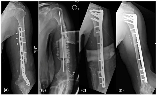 3D-Printing for Critical Sized Bone Defects: Current Concepts and ...