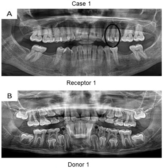 The Allogenic Dental Pulp Transplantation from Son/Daughter to Mother ...